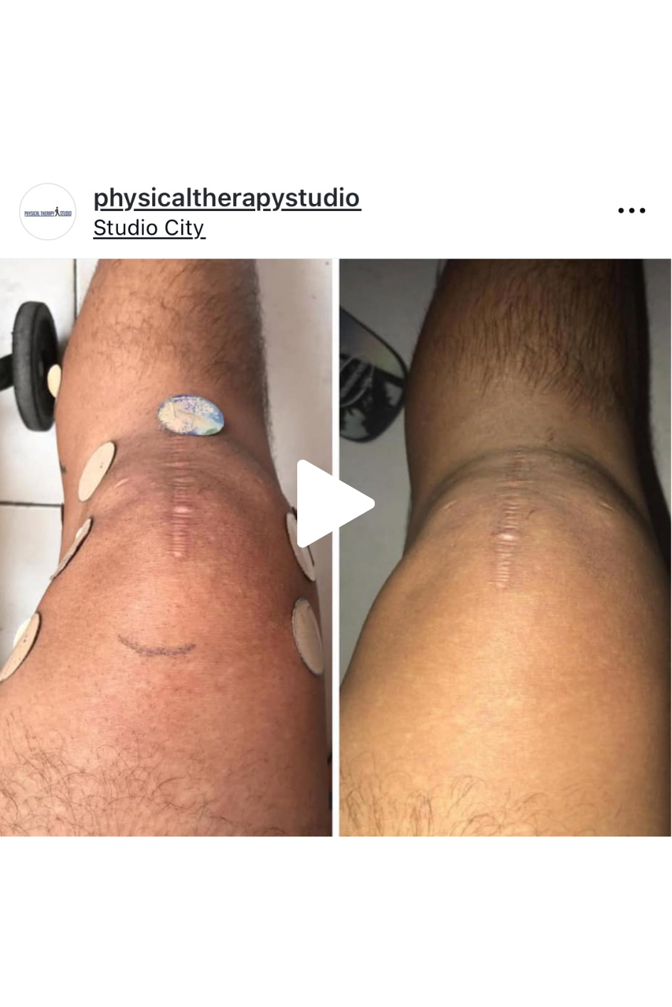 ANF Therapy - When nothing else helps!